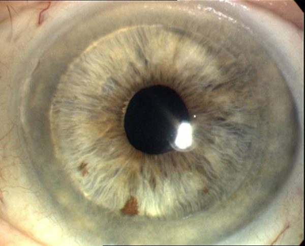 Corneal Transplant Surgery - Valerie Saw