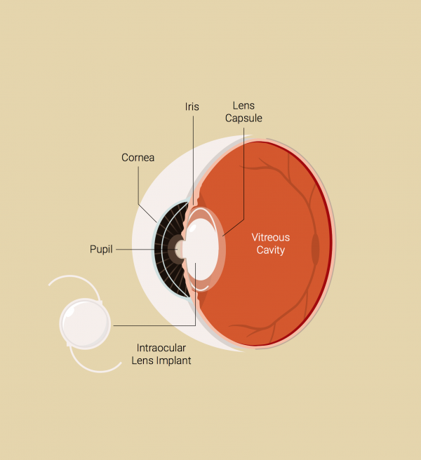 Dry Eye - Valerie Saw